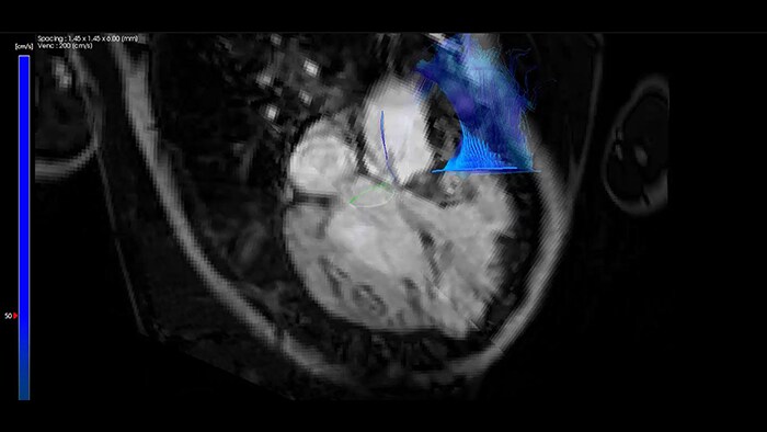 Congenital Heart Disease (CHD) | Philips