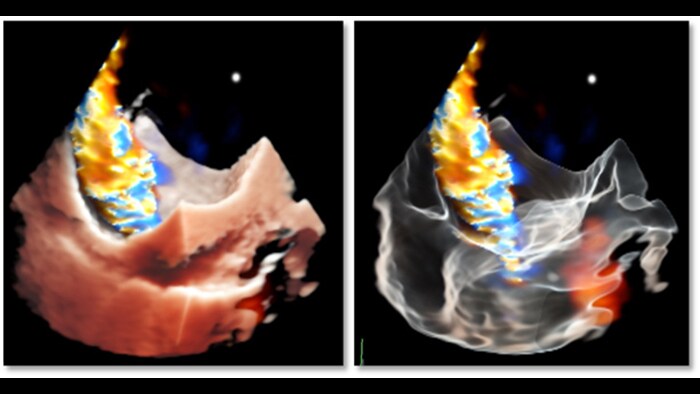 Congenital Heart Disease (CHD) | Philips