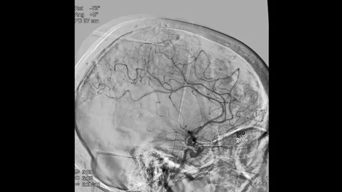 Ischemic stroke treatment | Philips
