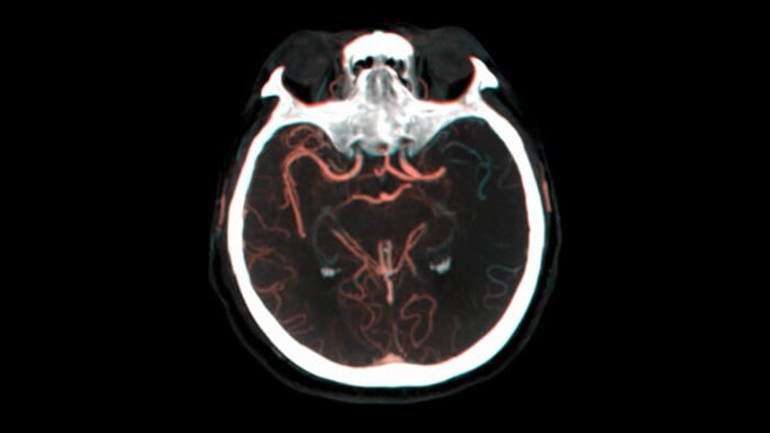 Ischemic stroke treatment | Philips