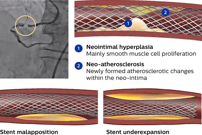 In-stent restenosis | Philips Healthcare