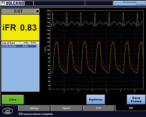 iFR and FFR help to guide PCI | Philips Healthcare