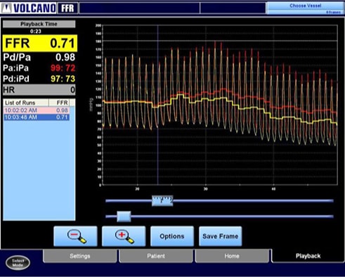 iFR and FFR help to guide PCI | Philips Healthcare