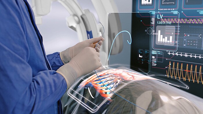 Prostate Artery Embolization (PAE) | Philips